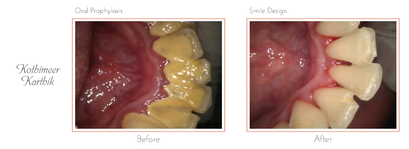 Studio Dental - Best Dental Hospital in Hyderabad - Dental Clinic ...