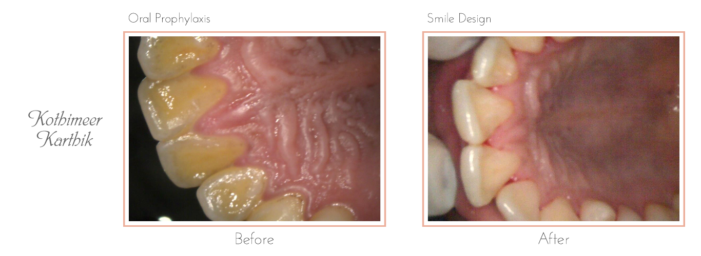 Studio Dental - Best Dental Hospital in Hyderabad - Dental Clinic ...